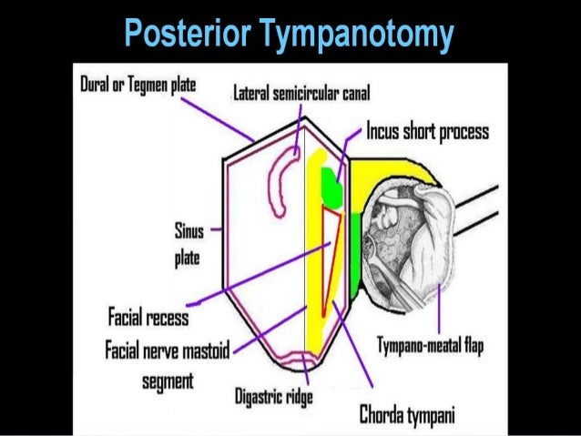 Mastoidectomy (by drdhiru456)