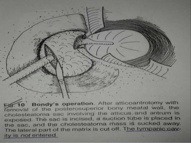 Mastoidectomy Draping