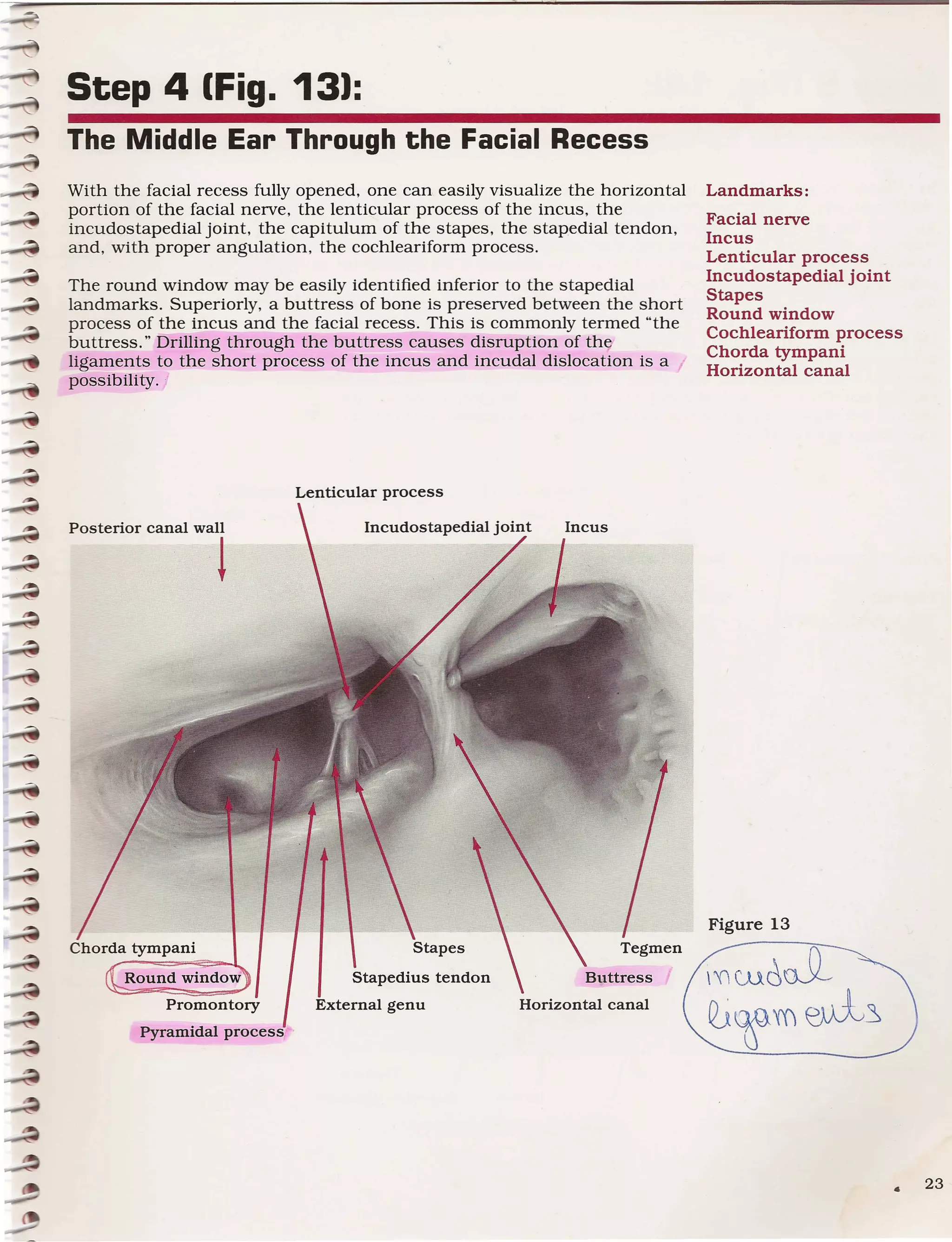 Mastoidectomy Epitympanum | PDF