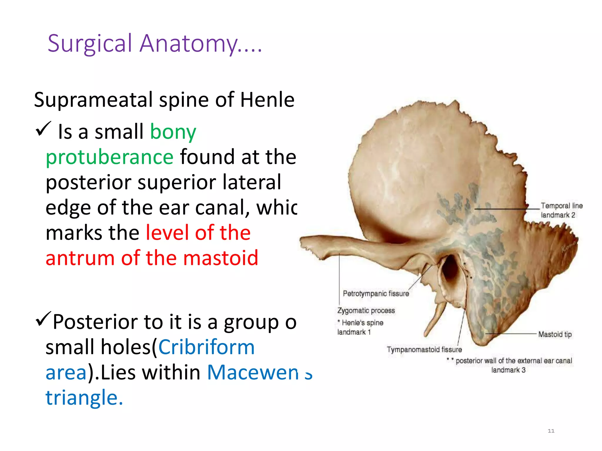 MASTOIDECTOMY PPT | PPT
