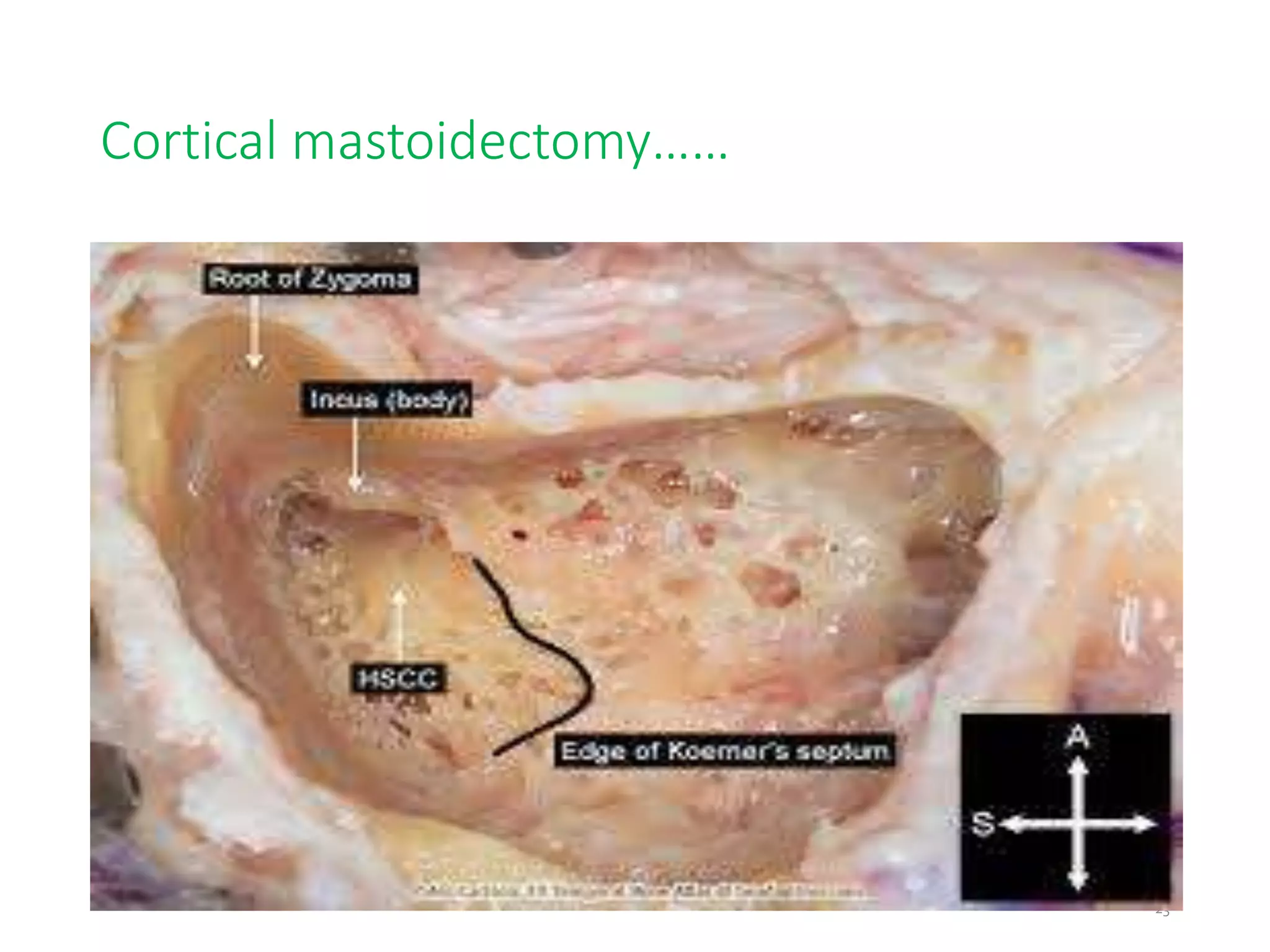 MASTOIDECTOMY PPT | PPT