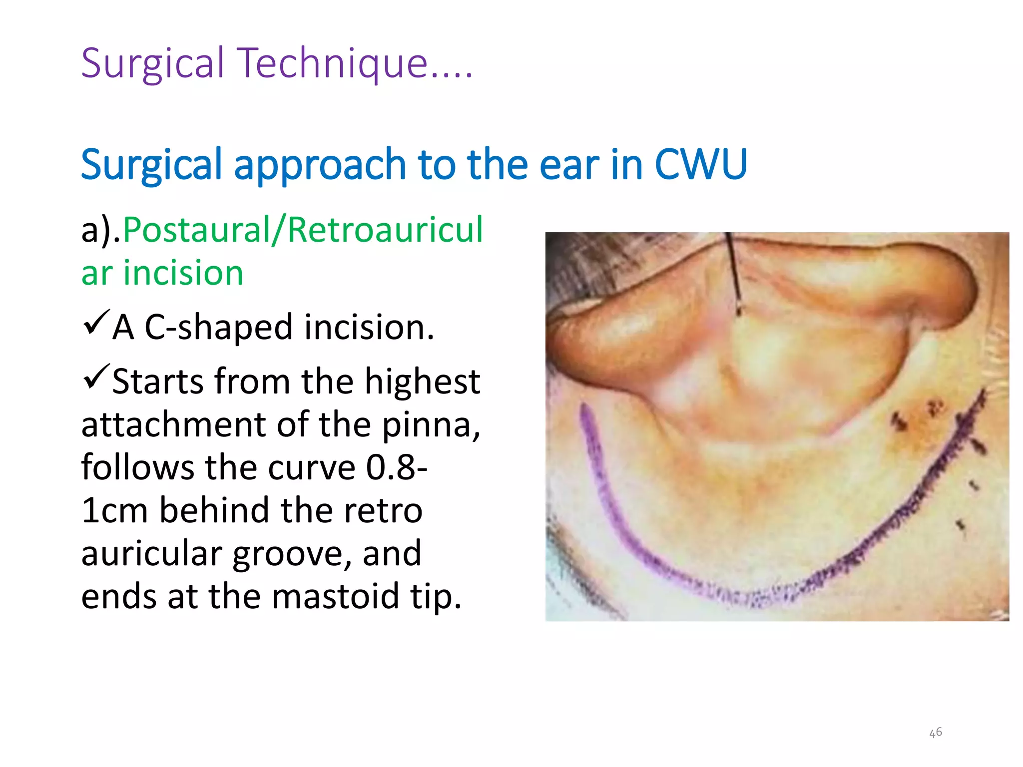 MASTOIDECTOMY PPT | PPT