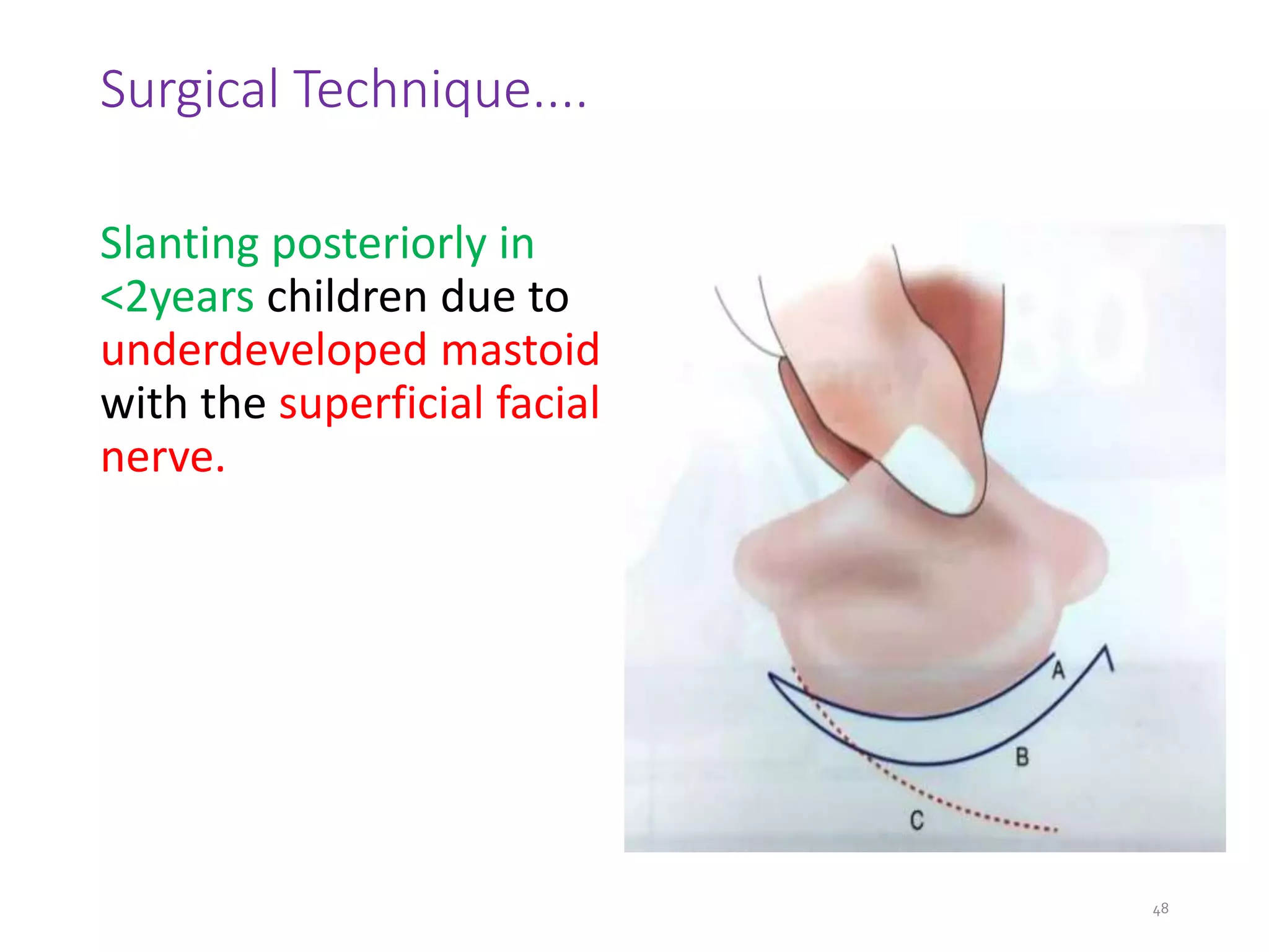 MASTOIDECTOMY PPT | PPT