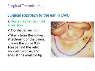 MASTOIDECTOMY PPT | PPT