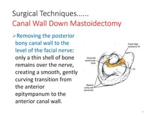 MASTOIDECTOMY PPT | PPT