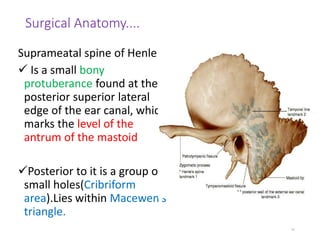 MASTOIDECTOMY PRESENTATION | PPT