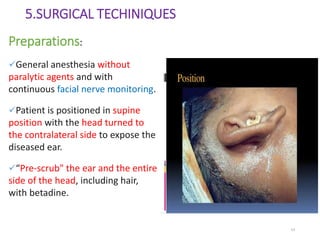 MASTOIDECTOMY PRESENTATION | PPT