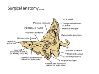 MASTOIDECTOMY PRESENTATION | PPT