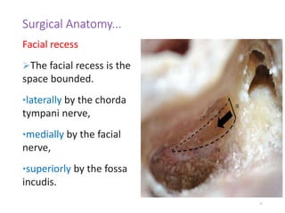 Facial Recess Approach