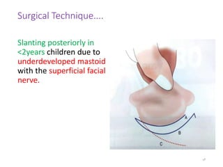 MASTOIDECTOMY PRESENTATION | PPT