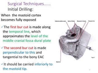 MASTOIDECTOMY PRESENTATION | PPT