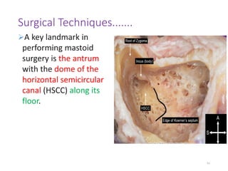 MASTOIDECTOMY PRESENTATION | PPT