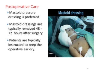 MASTOIDECTOMY PRESENTATION | PPT