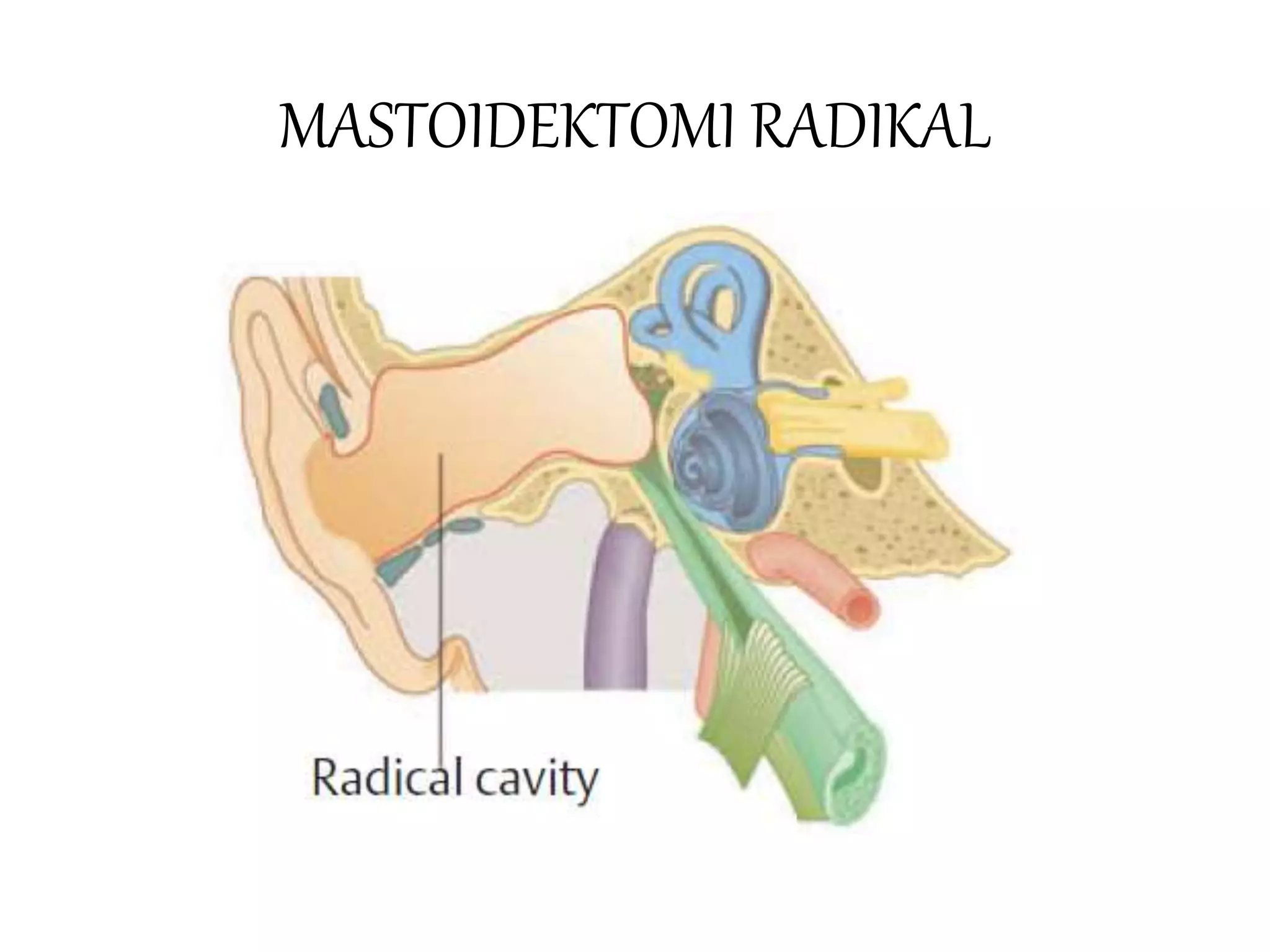 Mastoiditis | PPTX