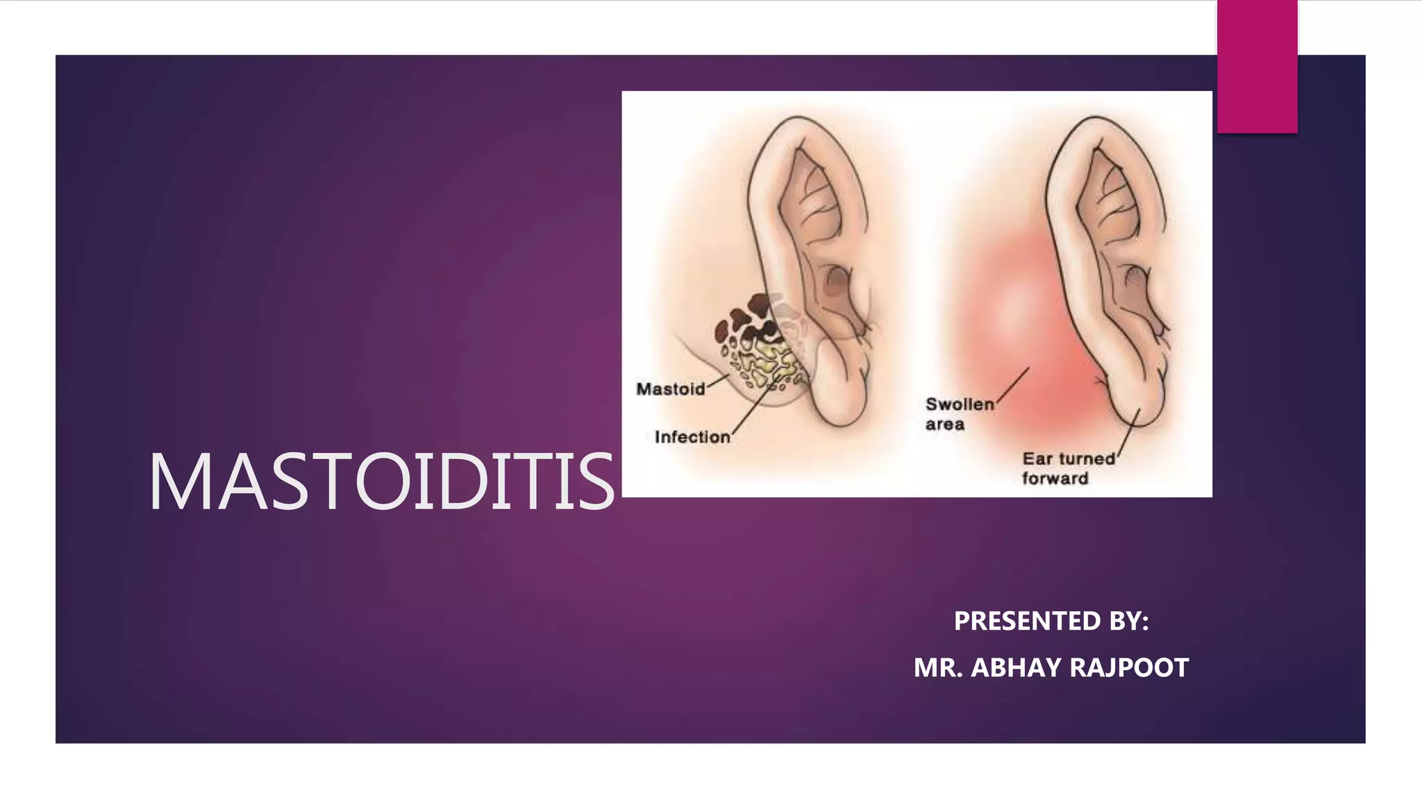Mastoiditis | PPTX