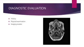 Mastoiditis | PPTX