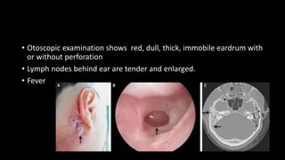 Mastoiditis | PPT