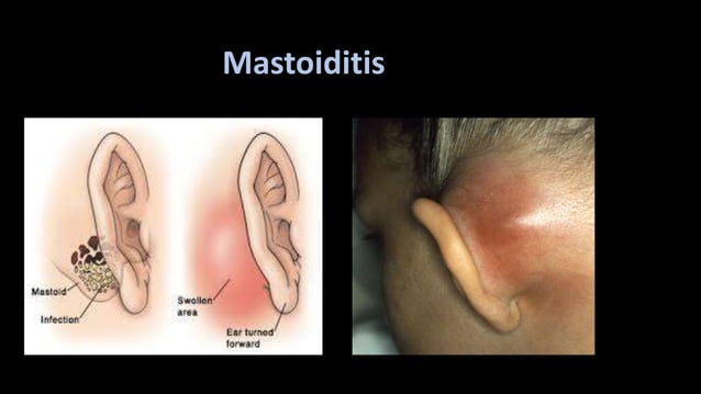 Mastoiditis | PPTX | Ear, Nose and Throat Conditions | Diseases and Conditions