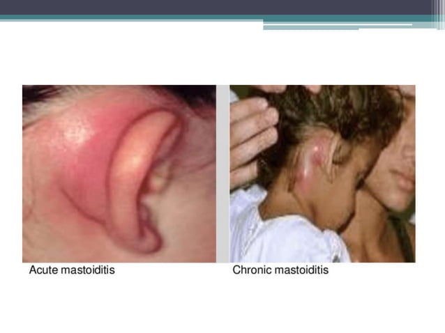 Mastoiditis | PPTX | Ear, Nose and Throat Conditions | Diseases and Conditions