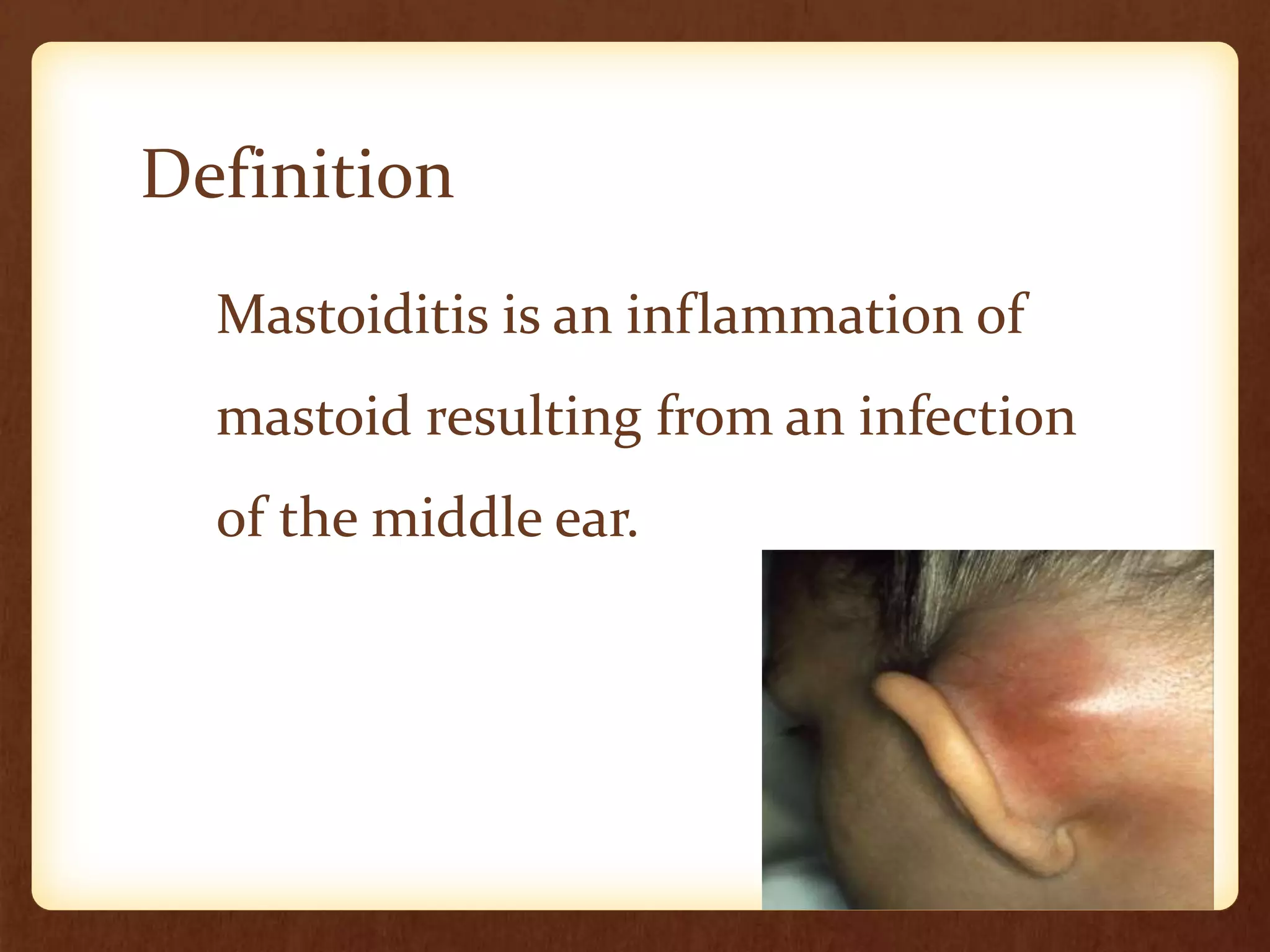 Mastoiditis | PPTX