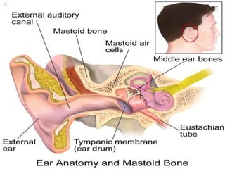 mastoiditis | PDF | Ear, Nose and Throat Conditions | Diseases and Conditions