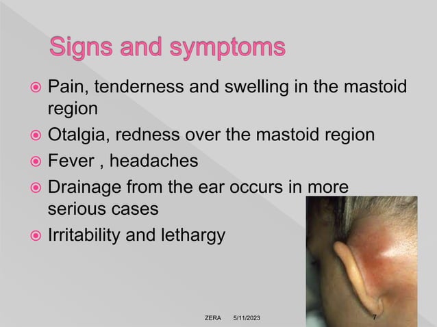 Mastoiditis.ppt