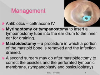 Mastoiditis.ppt
