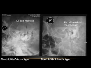 MASTOIDITIS.pptx