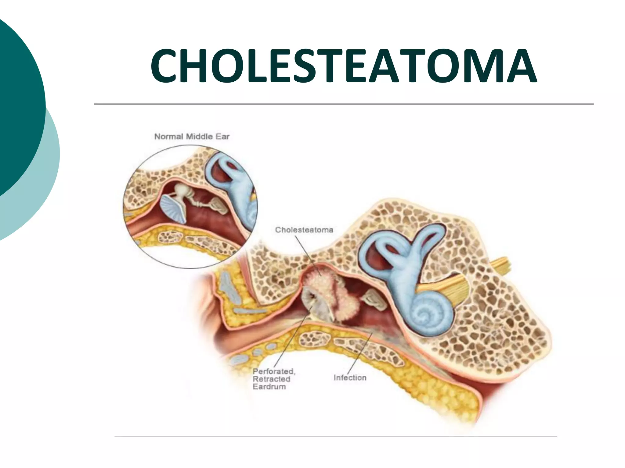 Mastoiditis | PDF