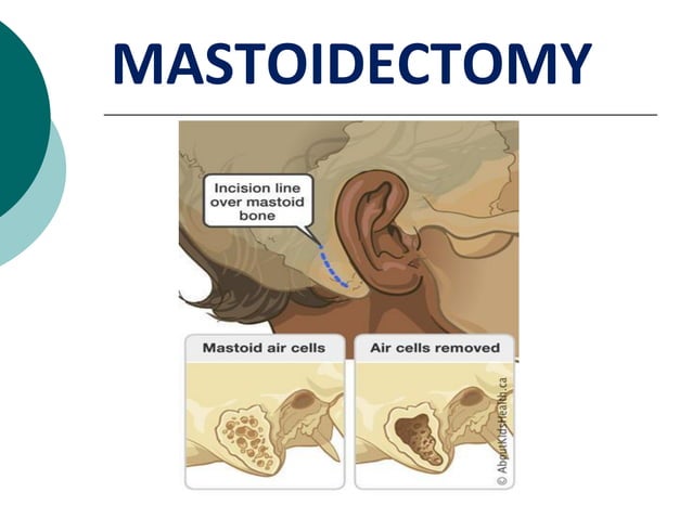 Mastoiditis | PDF