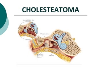 Pathophysiology Of Mastoiditis Slideshare
