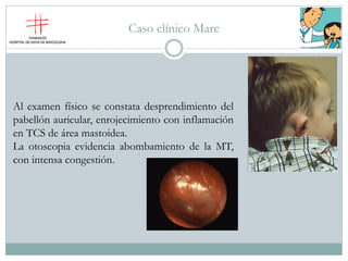 Tratamiento de la mastoiditis - XXVII Jornada Pediatría | PDF