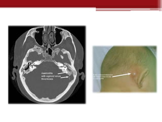 MASTOIDITIS AGUDA | PPTX