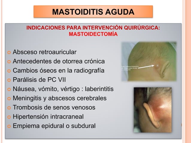 Mastoiditis aguda | PPTX