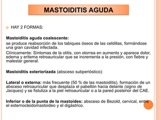 Mastoiditis aguda | PPTX