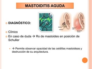 Mastoiditis aguda | PPTX