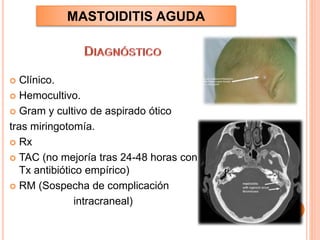 Mastoiditis aguda | PPTX
