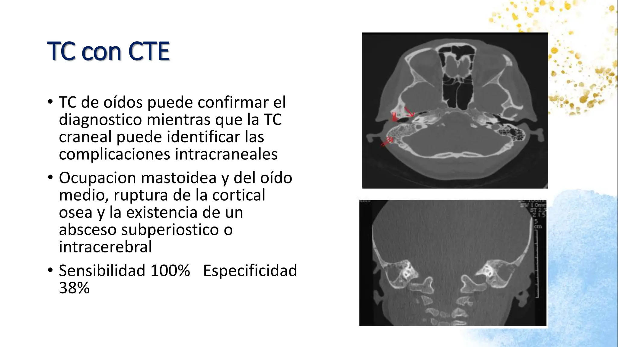 MASTOIDITIS AGUDA EN NIÑOS. Definicion, clasificacion y tratamiento | PPTX