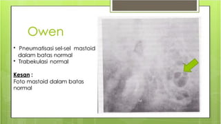 MASTOIDITIS fix kaisa pirgadi radiology gasken | PPT