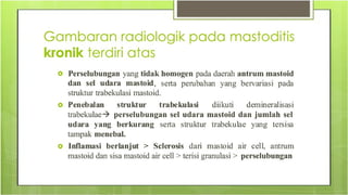 MASTOIDITIS fix kaisa pirgadi radiology gasken | PPT