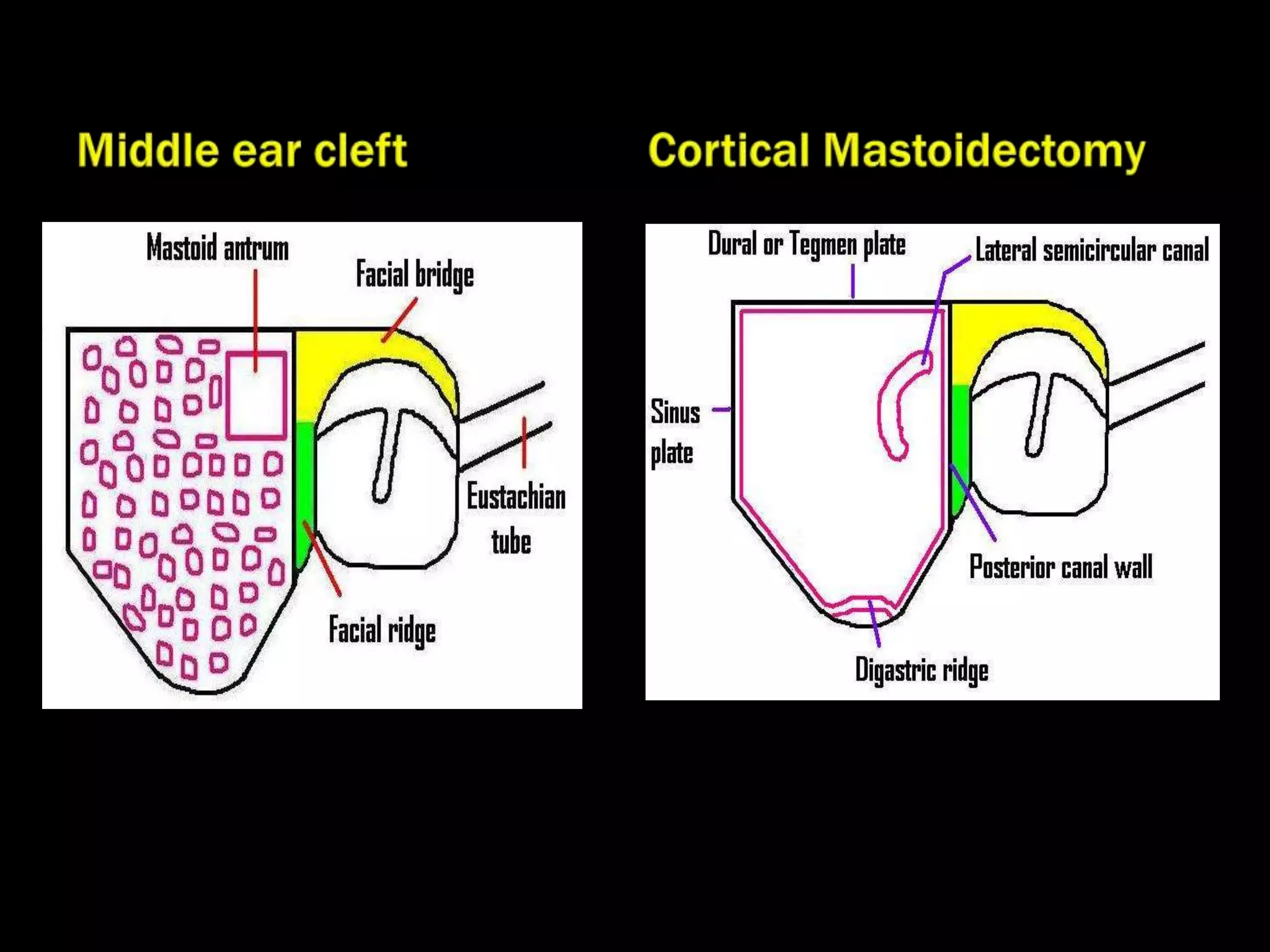 Mastoid surgeries KK .ppt