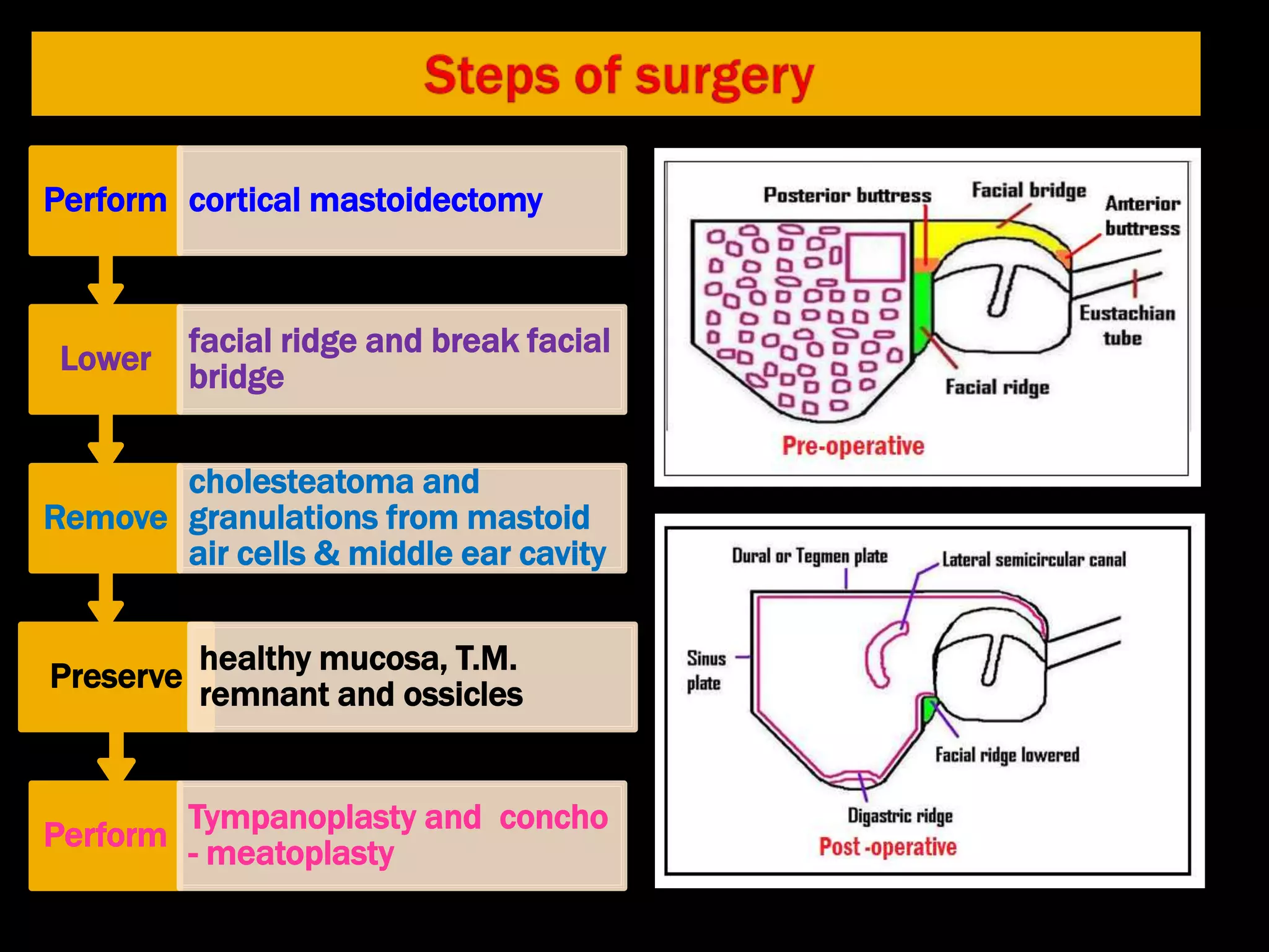 Mastoid surgeries KK .ppt