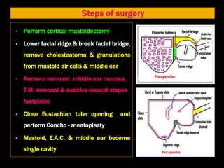 Mastoid surgeries KK .ppt