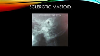 Comprehensive Mastoid X-Ray Imaging Techniques and Views Explained | PPTX