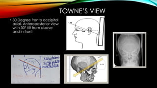 Comprehensive Mastoid X-Ray Imaging Techniques and Views Explained | PPTX