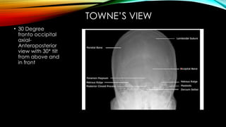Comprehensive Mastoid X-Ray Imaging Techniques and Views Explained | PPTX