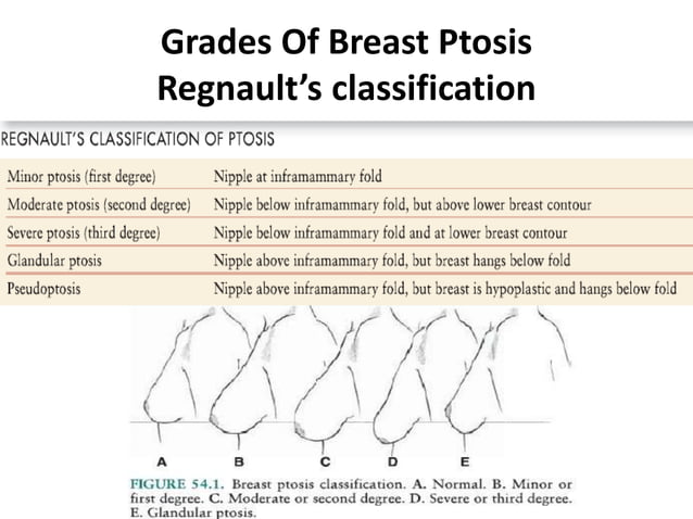 Mastopexy | PPTX | Cosmetic Medical Services | Medical Health