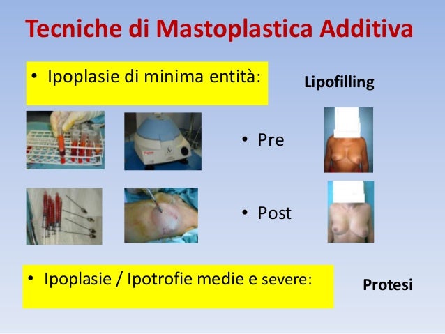 Mastoplastica additiva