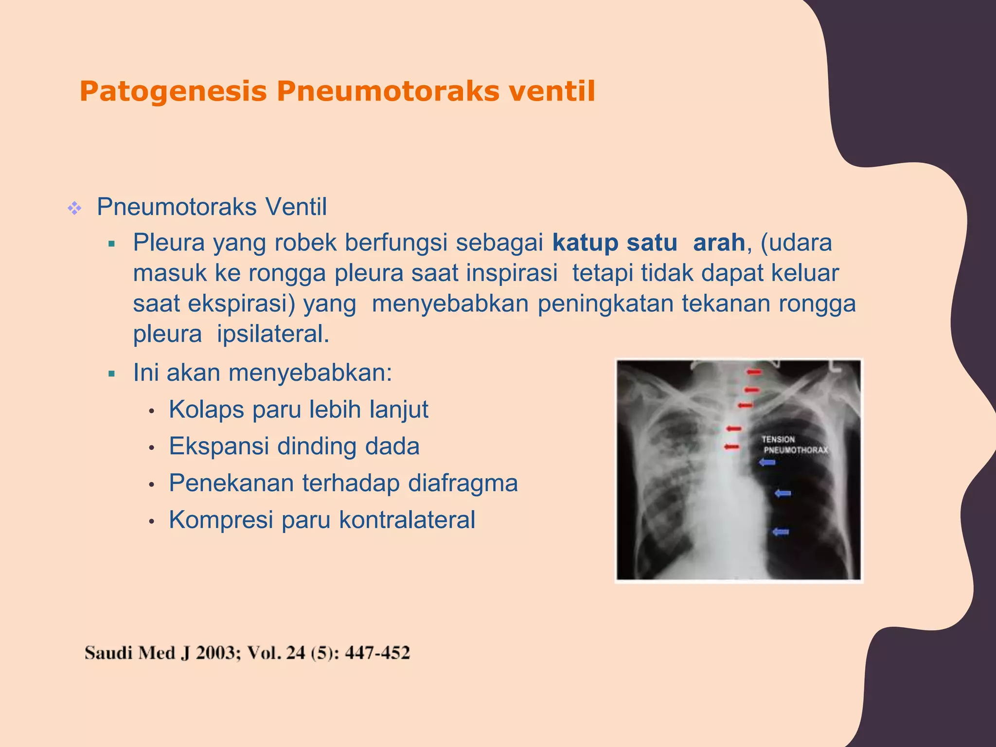 Masukan Ventil Pneumotoraks by Amalia.pptx