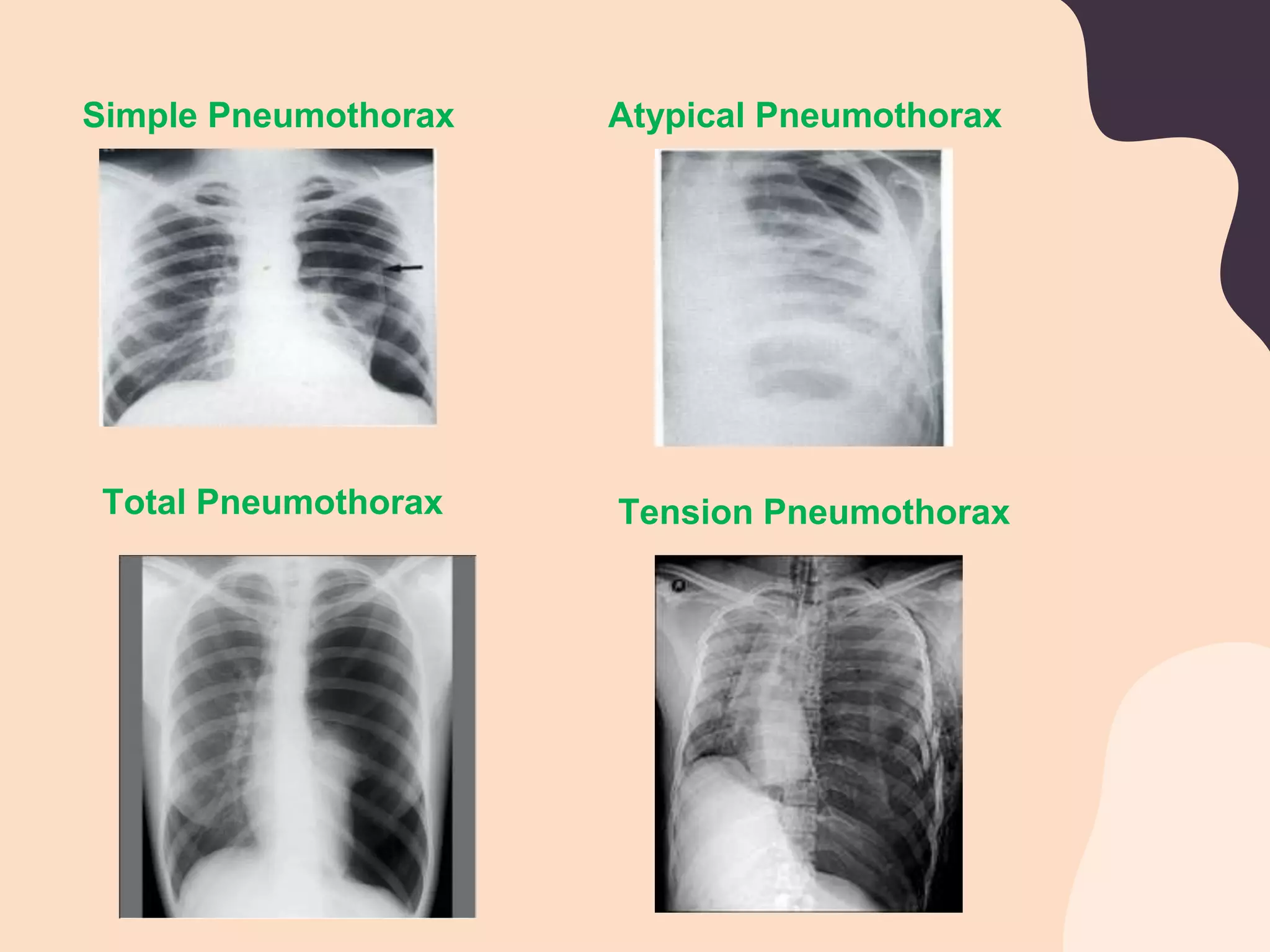 Masukan Ventil Pneumotoraks by Amalia.pptx